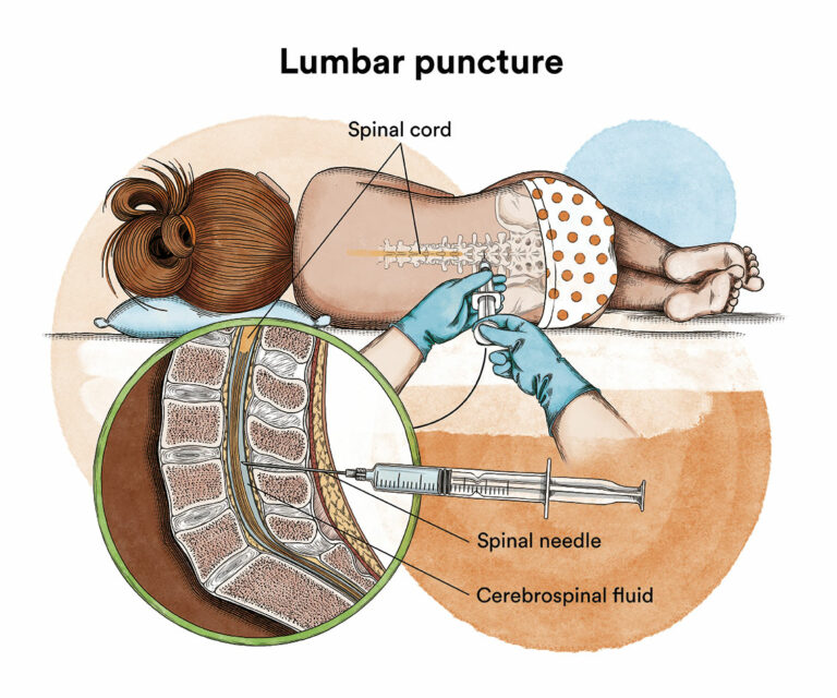 Acute myeloid leukaemia - Josep Carreras Foundation